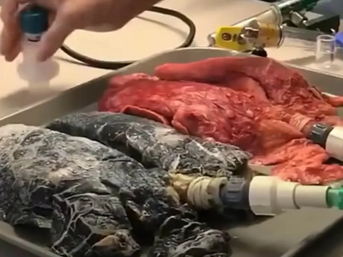 Así luce el pulmón de un fumador; médico explica terribles daños