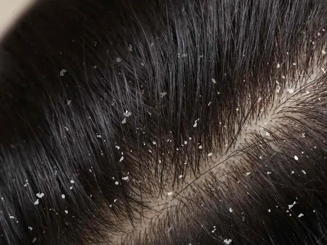 ¿Por qué sale caspa en el cabello? Causas y tratamientos