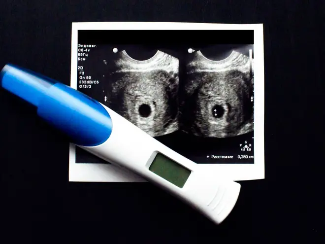 Qué es un embarazo anembrionario