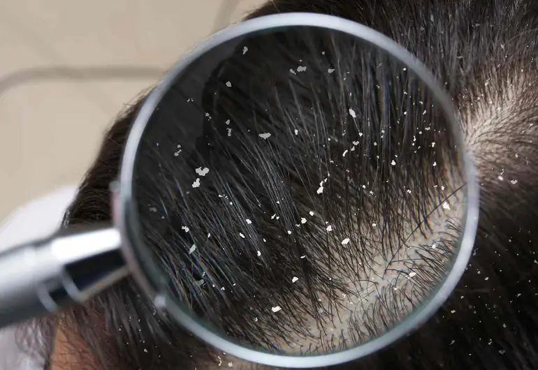 ¿Por qué sale caspa en el cabello? Causas y tratamientos