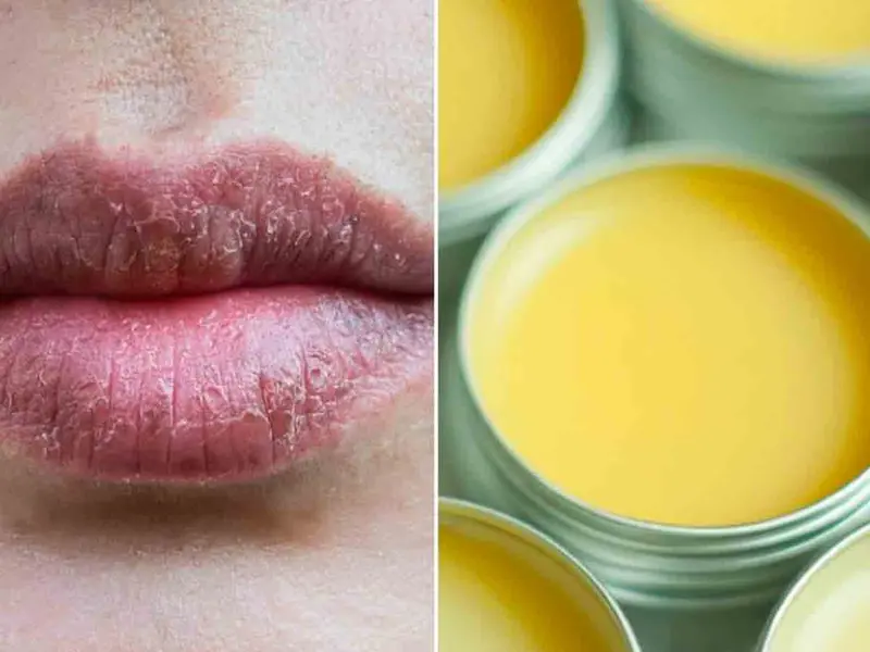 Remedio casero para curar labios partidos en épocas de frío