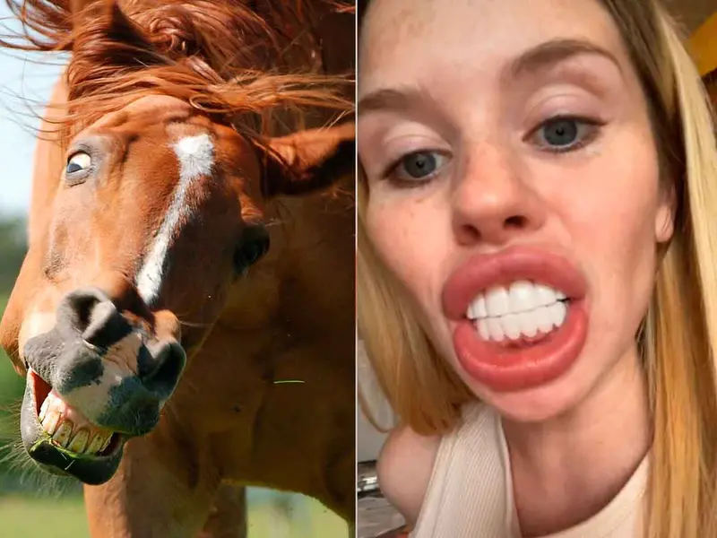 Joven se pone carillas dentales para lucir hermosa y ahora parece un ...