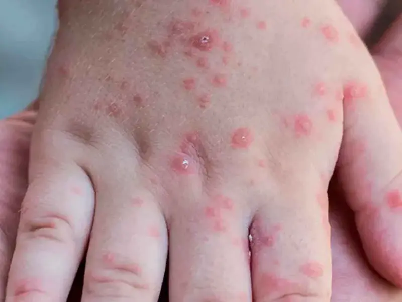 Brote de coxsackie en primaria de Oaxaca, obliga a suspensión de clases