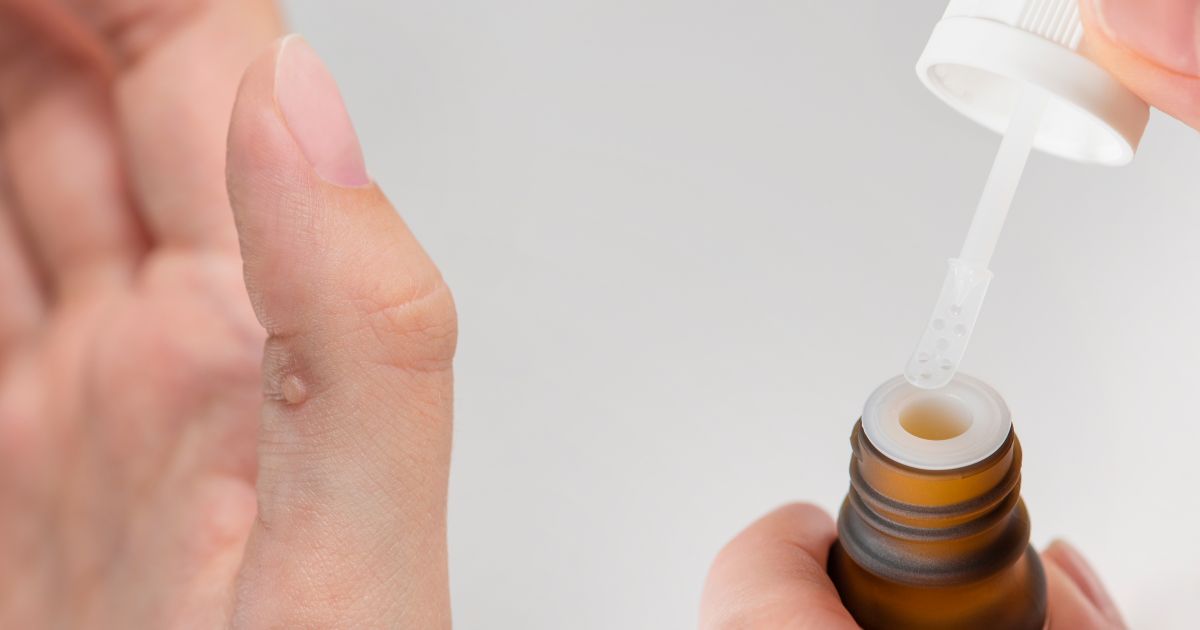 Verrugas por VPH: cómo identificarlas, tratarlas y prevenirlas